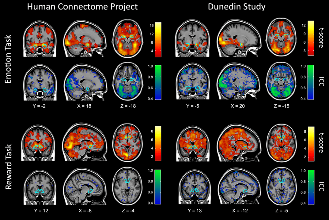 Imaging Fungsional Otak: Mengenal fMRI dan Teknologi Neuroimaging